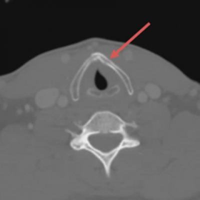 Thyroid Cartilage Fracture in Context of Noncompetitive "Horseplay ...