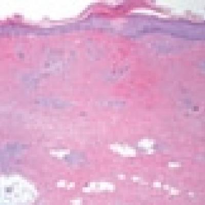 Livedoid Vasculopathy | MDedge Dermatology