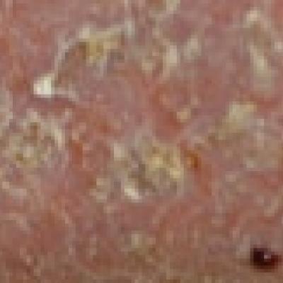 Id-Like Reaction to BCG Therapy for Bladder Cancer | MDedge Dermatology