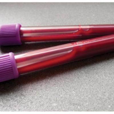 Pediatric Lipid Screening Uncommon Before 2011 Recommendations ...