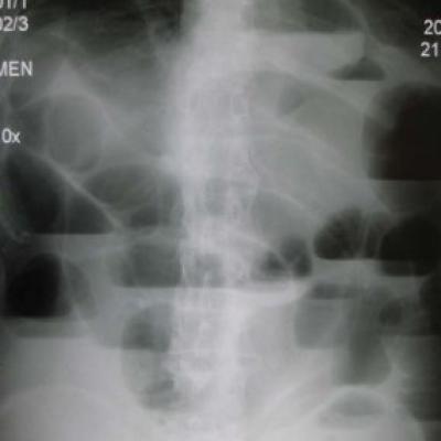 Early surgery for adhesive bowel obstruction can save lives | MDedge ...