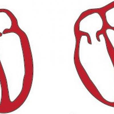 Stilling a Stroke Patient's Beating Heart | MDedge Cardiology