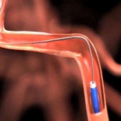 Solitaire Clot Remover Effective for Large Artery Stroke | MDedge ...