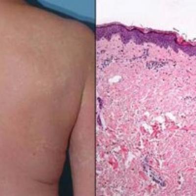 Vemurafenib After Ipilimumab Linked to Rash | MDedge Hematology and ...