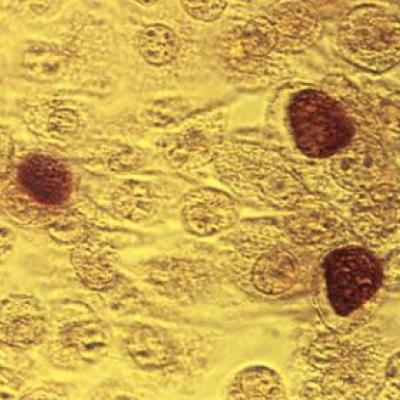 Nongonococcal urethritis: Time to ditch azithromycin? | MDedge Family ...