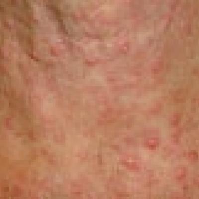 Acneiform Eruptions Induced by Epidermal Growth Factor Receptor ...