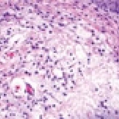 Eruptive Xanthoma | MDedge Dermatology