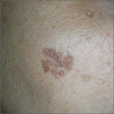 Brown spot on cheek | MDedge Family Medicine