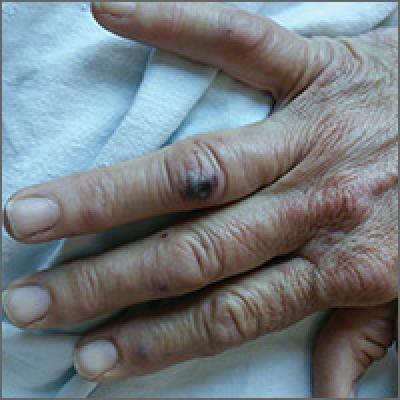 Fever, petechiae, and joint pain | MDedge Family Medicine