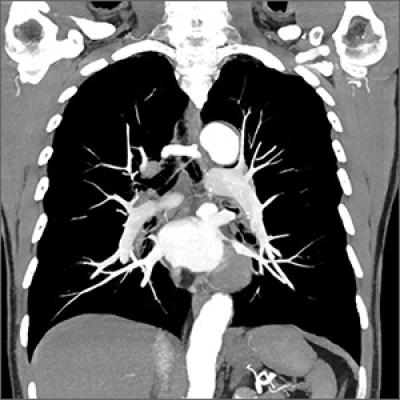 A better approach to the diagnosis of PE | MDedge Family Medicine