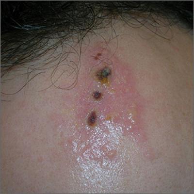 Spider Bite On Forehead