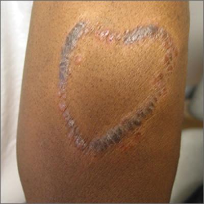 Red Rash Tattoos