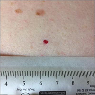 Red lesion on back | MDedge Family Medicine