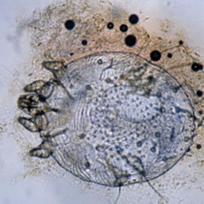 Scabies: Refine your exam, avoid these diagnostic pitfalls | MDedge ...