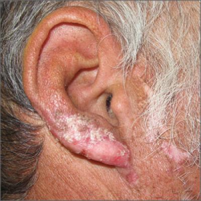Ear and nose plaques | MDedge Family Medicine