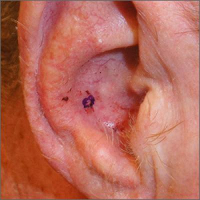 A hard-to-reach bleeding lesion | MDedge Family Medicine
