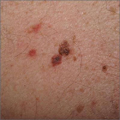 Outlier lesion on the back | MDedge Family Medicine