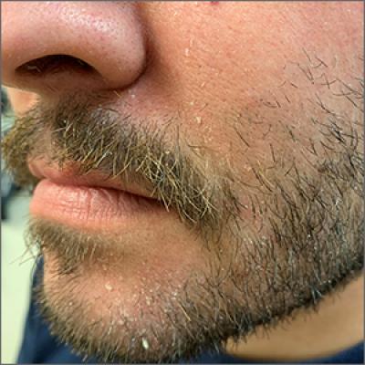 Scaly beard rash | MDedge Family Medicine