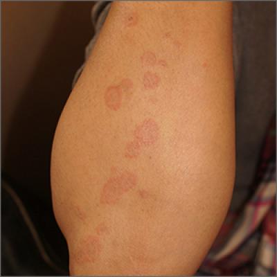 Targetoid eruption | MDedge Family Medicine