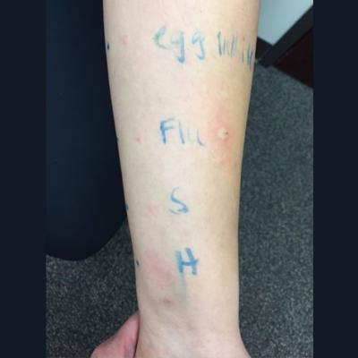 25-year-old woman • abdominal pain • urticarial rash • recent influenza ...