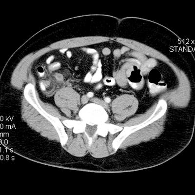 A practical guide to appendicitis evaluation and treatment | MDedge ...