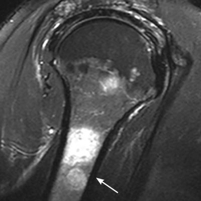 58-year-old man • bilateral shoulder pain • history of prostate cancer ...