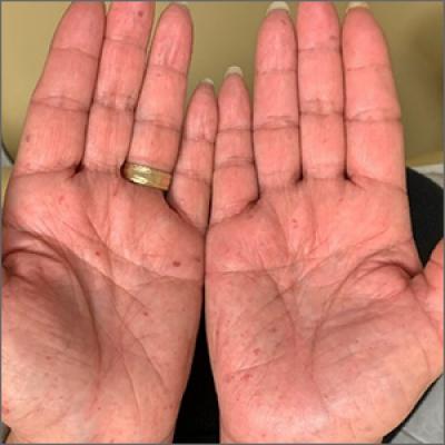 Bilateral palmar rash | MDedge Family Medicine