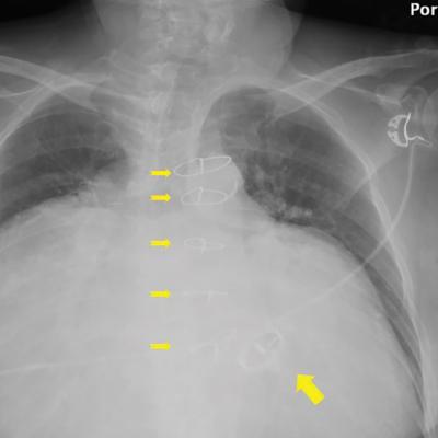 Substantially enlarged cardiac silhouette | MDedge Family Medicine