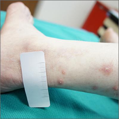Leg lesions | MDedge Family Medicine