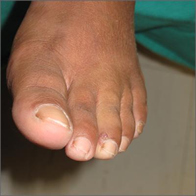 Toe growth | MDedge Family Medicine