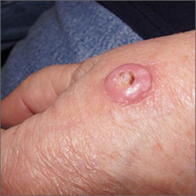 Fast growing hand lesion | MDedge Family Medicine