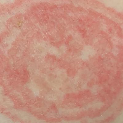 A worsening abdominal rash | MDedge Family Medicine