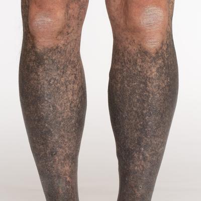 Blue-black hyperpigmentation on the extremities | MDedge Family Medicine