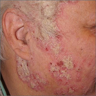 Scaly facial plaques | MDedge Family Medicine