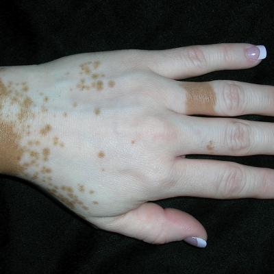 Vitiligo | MDedge Family Medicine