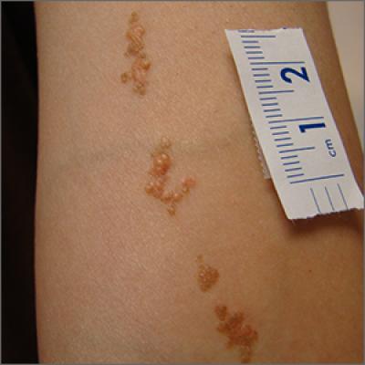 Longitudinal arm lesion | MDedge Family Medicine