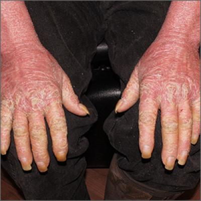 Widespread flaky red skin | MDedge Family Medicine