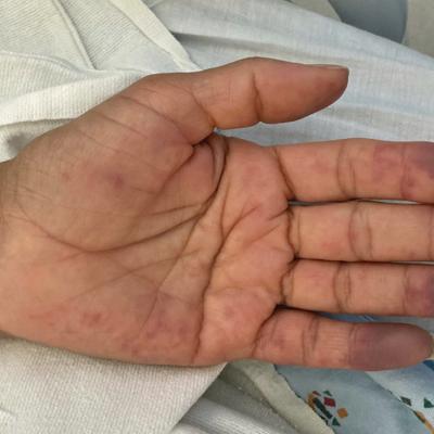 Painful blue fingers | MDedge Family Medicine