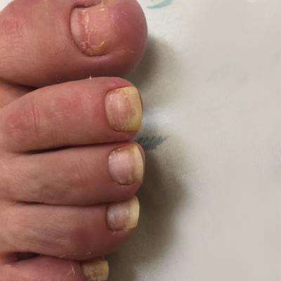 75-year-old man • recent history of hand-foot-mouth disease ...
