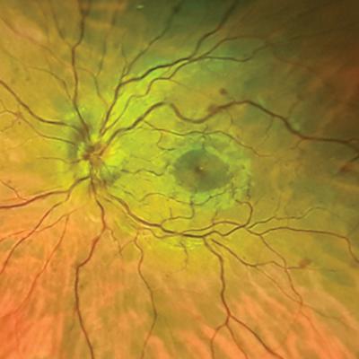 Acute unilateral visual disturbance | MDedge Family Medicine