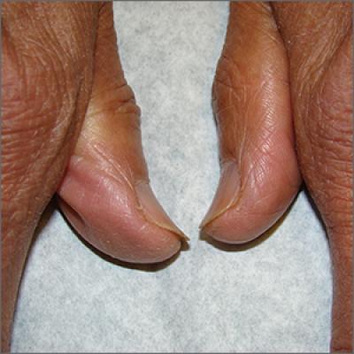 Brittle fingernails | MDedge Family Medicine