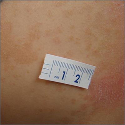 Itchy scaling rash | MDedge Family Medicine