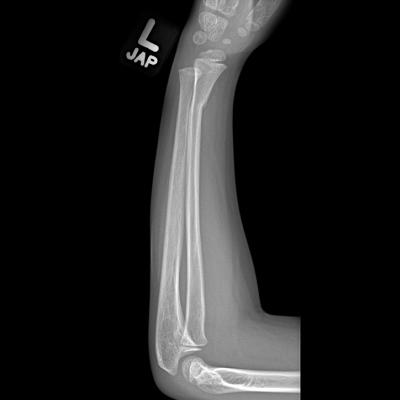 A new standard for treatment of torus fractures of the wrist? | MDedge ...