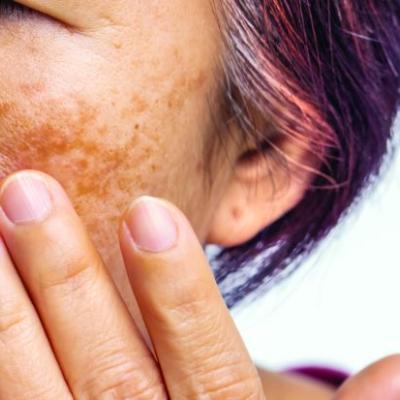 Cysteamine and melasma | MDedge Dermatology