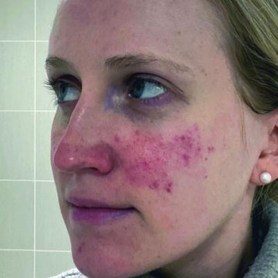 A Neurotoxin, an Antidepressant, and More Emerging Options for Treating ...