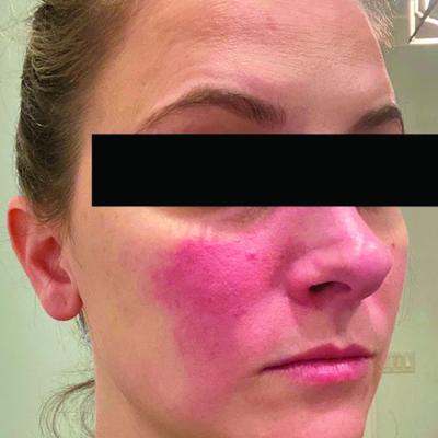 Rosacea and the gut: Looking into SIBO | MDedge Dermatology