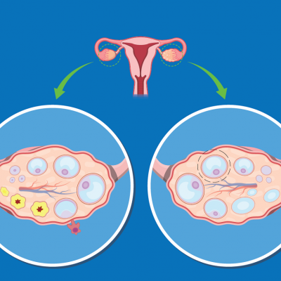 Obesity pegged as source of marked increased risk of diabetes in PCOS ...