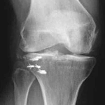 Hinged-Knee External Fixator Used to Reduce and Maintain Subacute ...