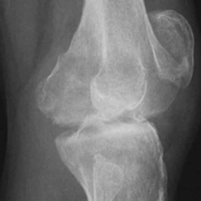 A Rare Case of Spontaneous Fusion of the Knee | MDedge Surgery