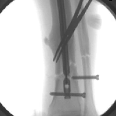 Removal of the Distal Aspect of a Broken Tibial Nail | MDedge Surgery